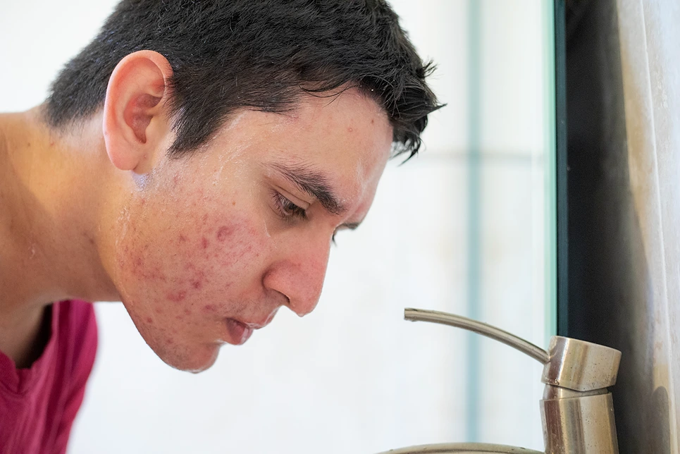 Outsmarting Testosterone-Triggered Acne